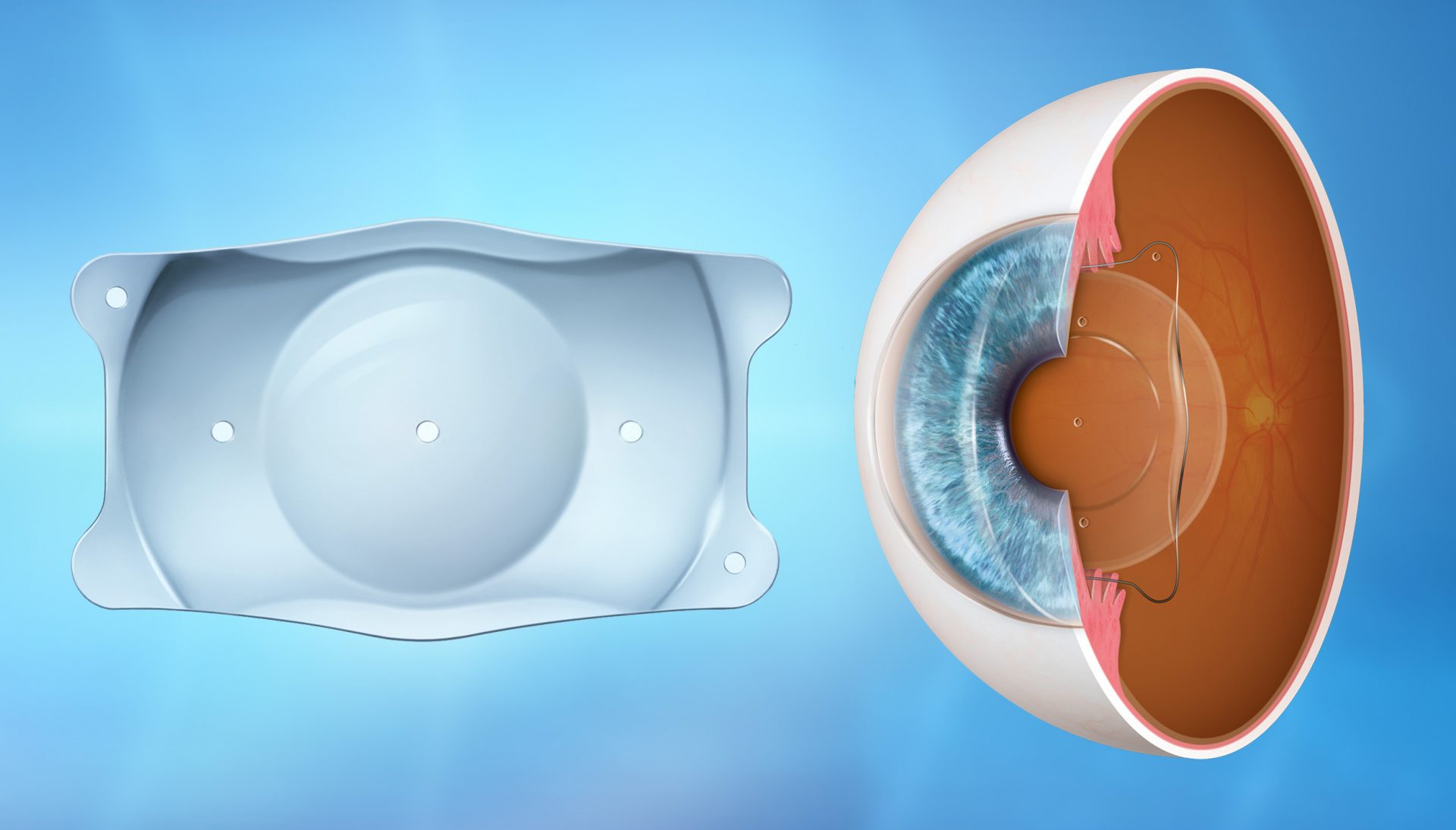 LASIK Treatment - Glacier Eye